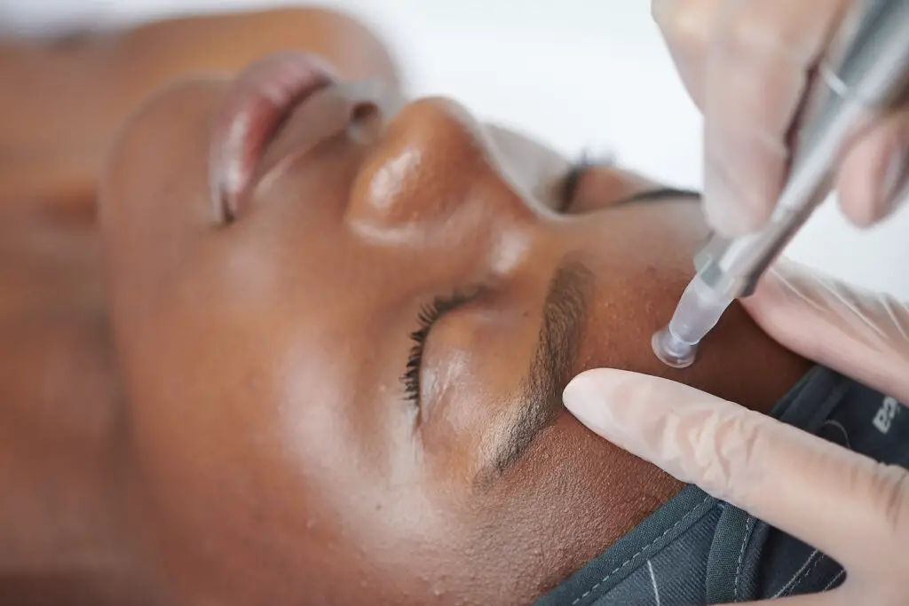 Microdermabrasion vs Microneedling: Which One Is For You?