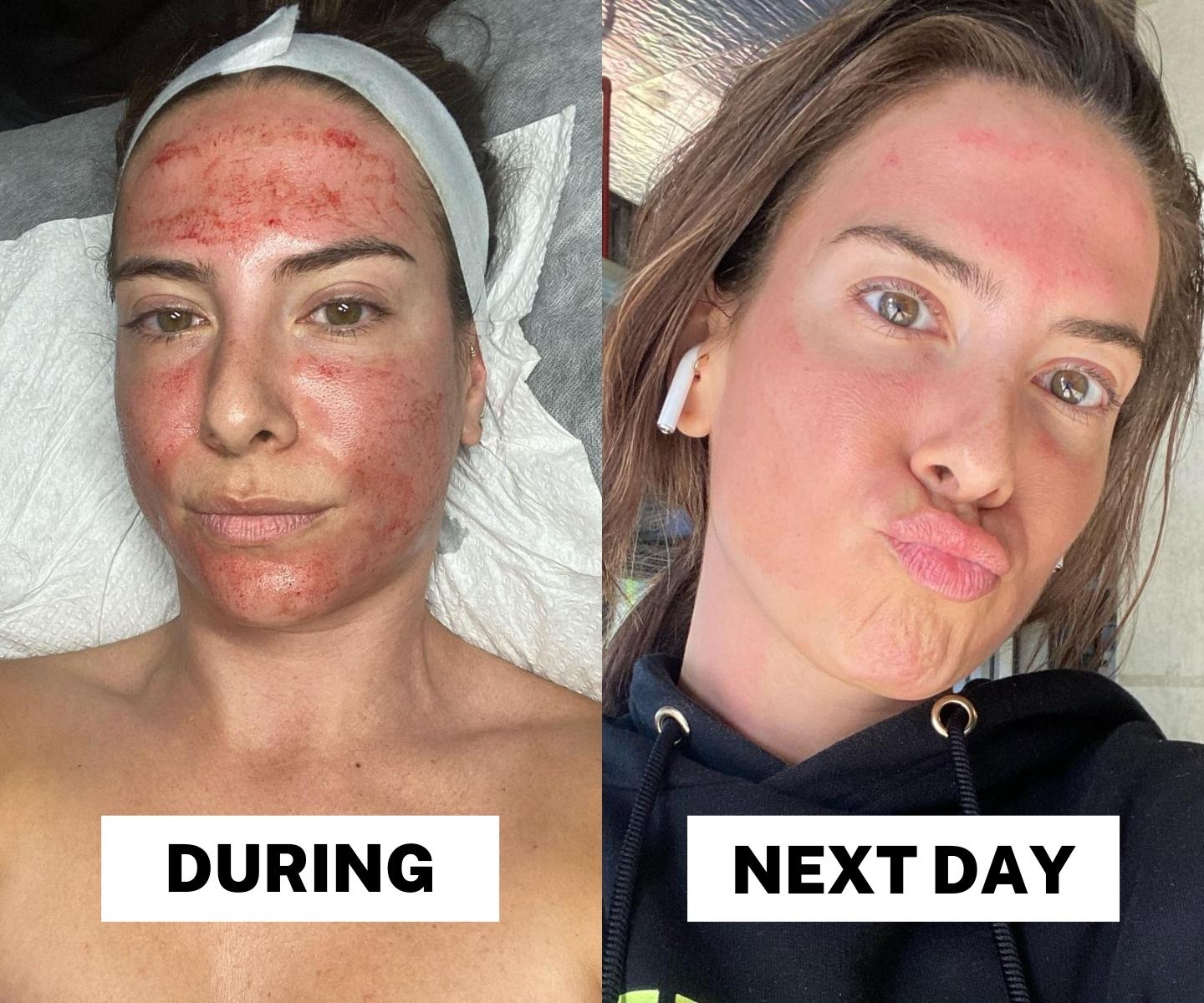 What Is Microneedling - Here Is Everything You Need To Know